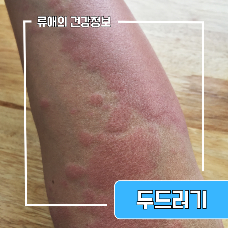급성 두드러기 증상 원인 치료 알레르기성 한랭두드러기 증상 네이버 블로그