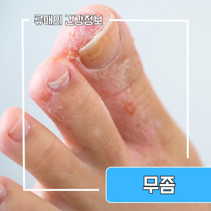 발가락무좀초기증상 원인 치료 예방 바르는 발톱무좀치료약 먹는약 네이버 블로그