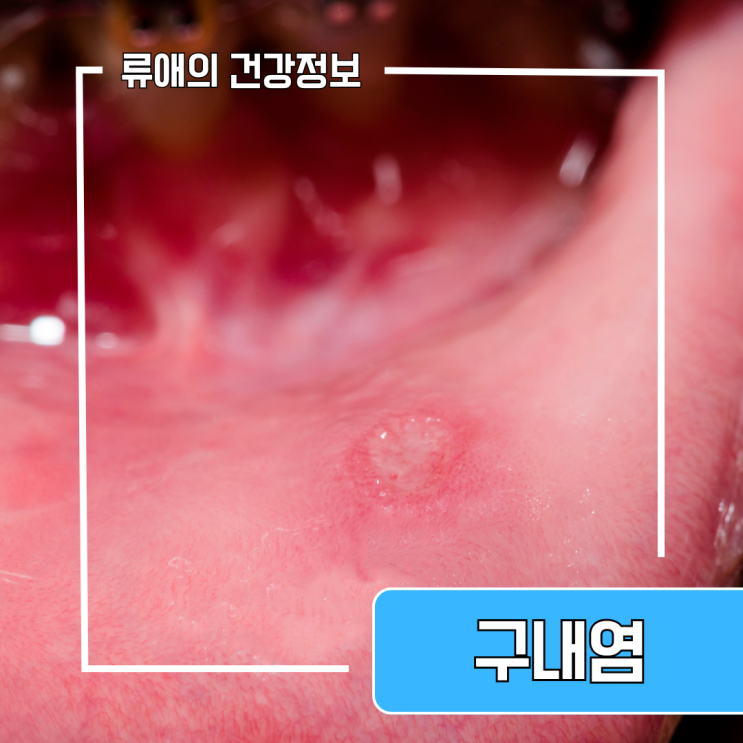 잘 모르는 구내염빨리낫는법 6가지 유형 입안 구내염 원인 약 정보 공유 네이버 블로그