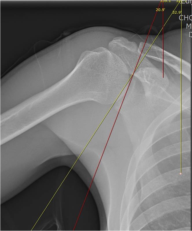Shoulder Axial view 변형 촬영법 : 네이버 블로그