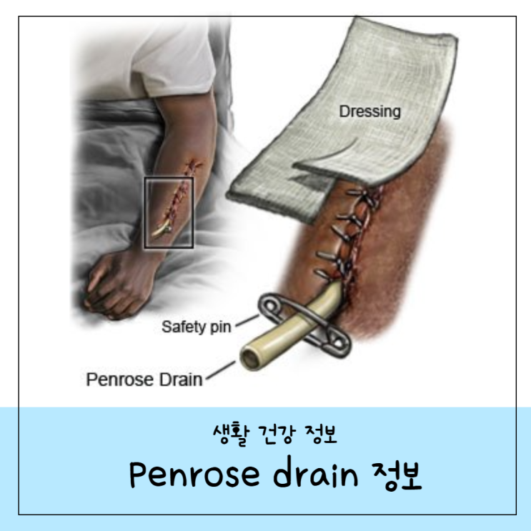 Penrose drain 펜로즈 수술 후 체액 배출 정보 : 네이버 블로그