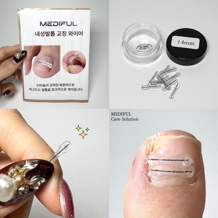 파고드는 엄지 발톱 수술없이 셀프 내성발톱 교정기 와이어 교정 자가치료 방법 내돈내산 추천 후기 네이버 블로그