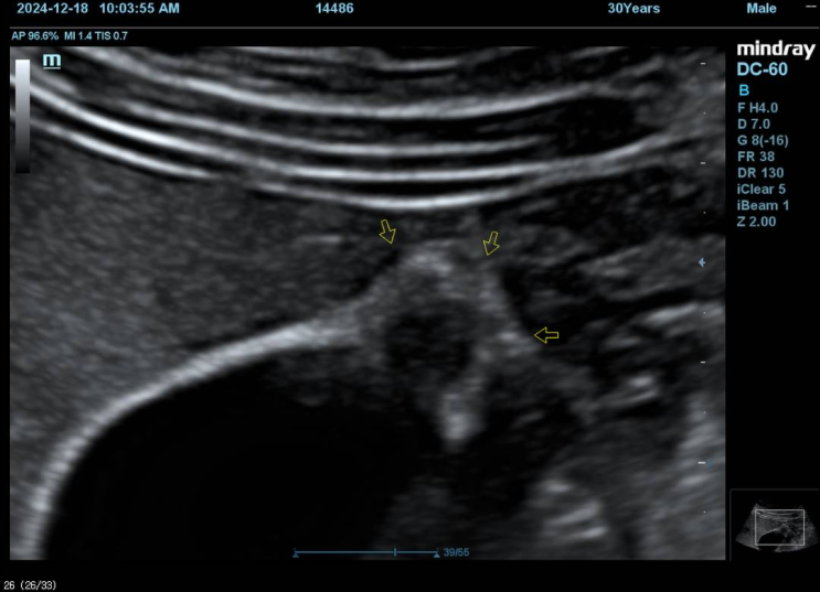 fundal type of adenomyomatosis(담낭 선근종증)/ polyps(담낭 용종) : 네이버 블로그
