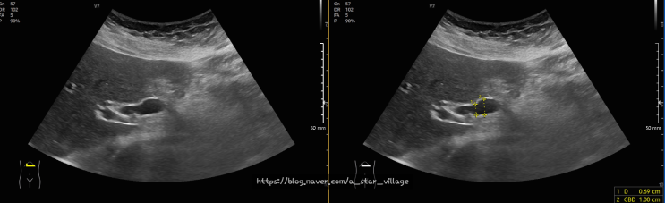 CBD dilatation (담관 확장) : 네이버 블로그