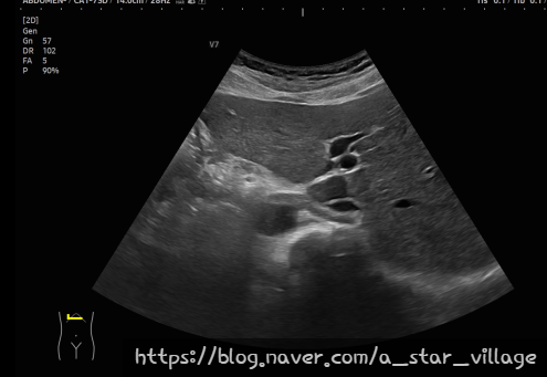 Situs inversus totalis (전내장역위증) : 네이버 블로그