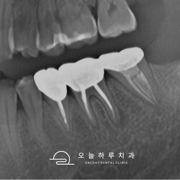 문정동치과 재신경치료(re-endo) 리엔도 케이스 자연치아살리기 : 네이버 블로그