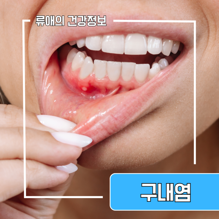 입안 구내염 증상 원인 연고 목 구내염 빨리 낫는법 네이버 블로그