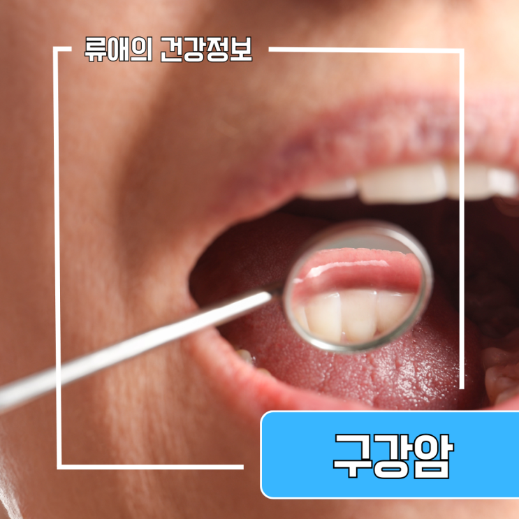 구강암전조증상 및 진단 혀암증상 구강암 4기 네이버 블로그
