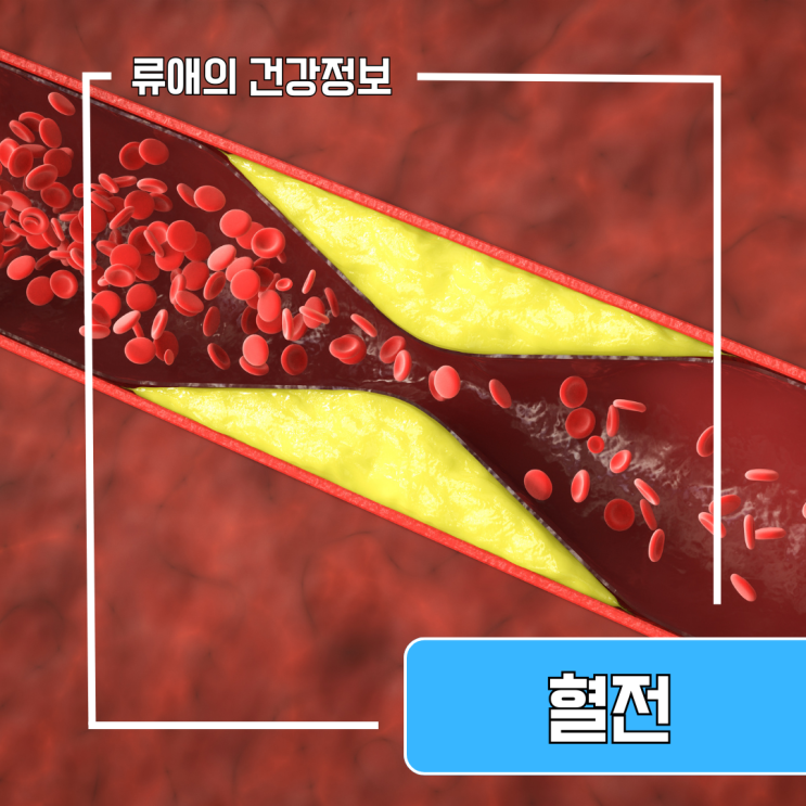 혈전초기증상 멍 및 치료 혈전 없애는법 녹이는 성분 네이버 블로그