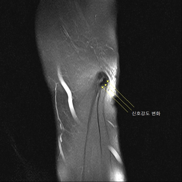 [내상과염;골프 엘보우(Golfer's elbow)] 의 수술적 치료 ; FETOR technique : 네이버 블로그