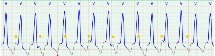 등율성 방실해리(Isorhythmic AV dissociation)란 : 네이버 블로그