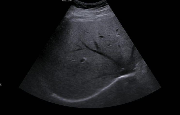지방간(Fatty liver)등급 분류 - mild·moderate·severe : 네이버 블로그