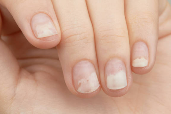 손톱무좀, 손톱무좀약 임산부무좀, 임산부무좀약 : 네이버 블로그