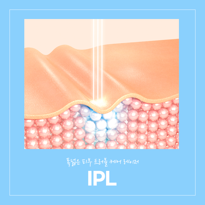 폭넓은 피부 트러블 케어엔 김포 구래동 피부과의원 연세BK의원 IPL : 네이버 블로그