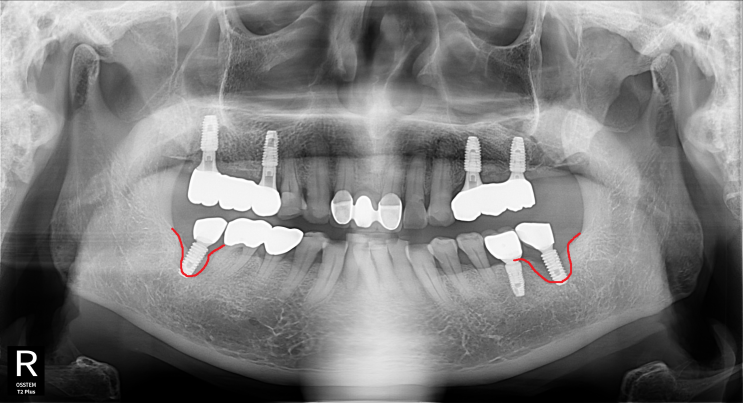 임플란트 재시술 사례 인천 구월동 치과 만수동치과 : 네이버 블로그