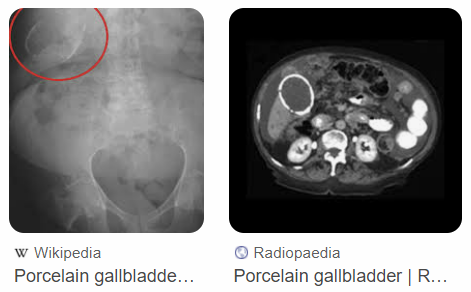 [USMLE review] porcelain gallbladder, 석회쓸개, 자기양담낭 : 네이버 블로그