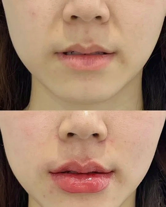 피부과 모공탄력 쥬베룩 스킨 부스터 2CC 4CC 효과 가격 비교 후기 : 네이버 블로그