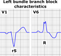LBBB, RBBB, fragmented QRS, 심실비대(LVH, RVH) EKG 심전도, 원인, 증상, 치료 : 네이버 블로그