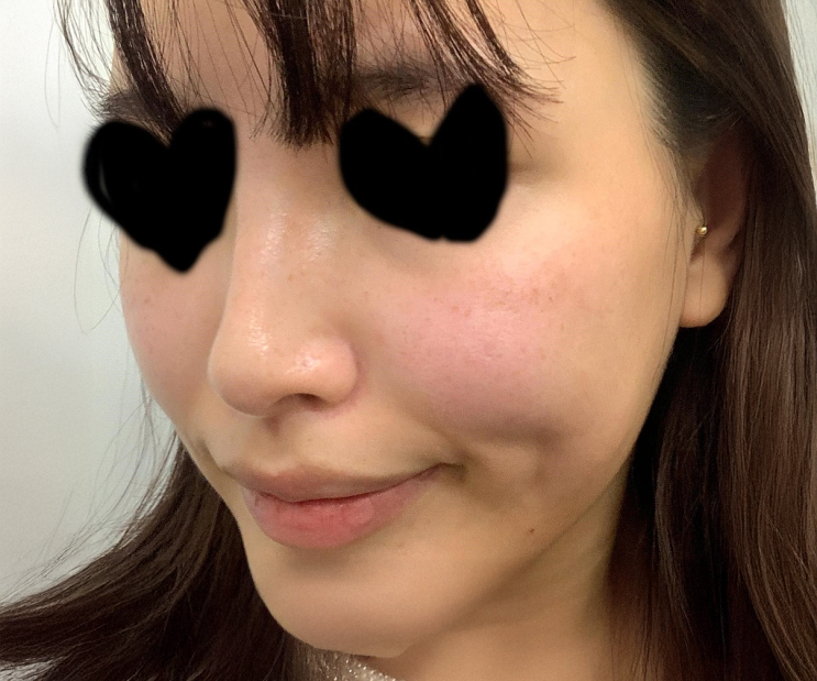 주근깨레이저 주근깨제거 시술 비포애프터 후기 네이버 블로그