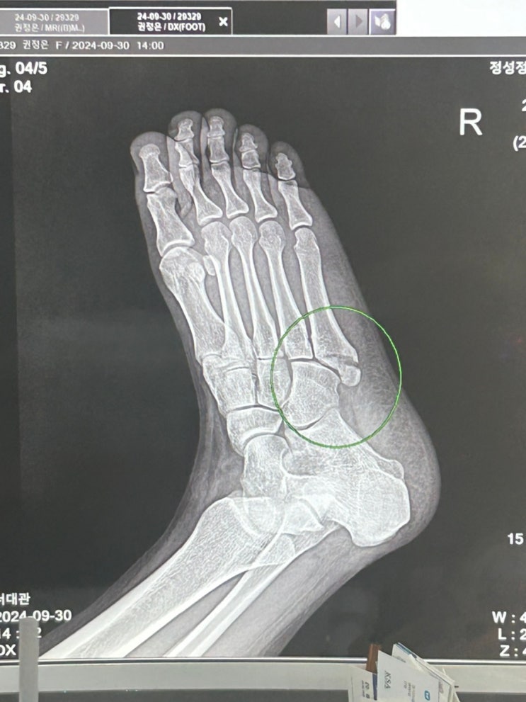 제 5 중족골 골절 수술 이야기 (feat. 입원준비물) : 네이버 블로그