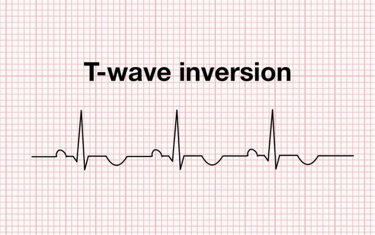 T파(T-wave inversion, Tall T)와 ST분절(ST elevation, ST depression)이상 EKG ...