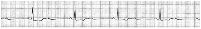 AV block: 2nd degree, fixed ratio block : 네이버 블로그