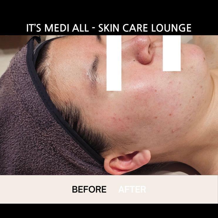 창원 문제성 피부 관리 잘하는 곳에서 알려주는 피부장벽 무너지면 생기는 진짜 문제, 홍조조 피부 방치하면 위험해요 : 네이버 블로그