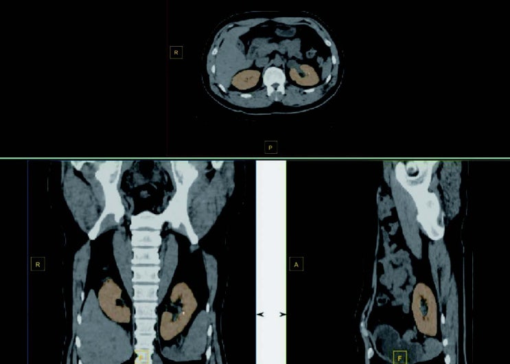 신기능을 평가하는 영상검사(Kidney SPECT, DTPA GFR Scan, MAG3 Scan) : 네이버 블로그