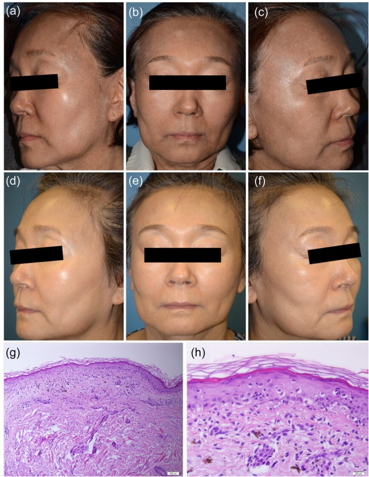 염색 후 얼굴이 시커매졌어요 - 릴 흑피증 (Riehl's melanosis)에 대해서 아시나요? : 네이버 블로그