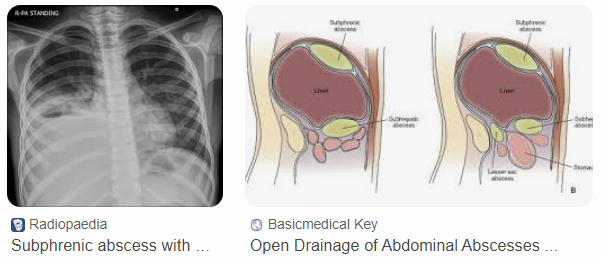 [USMLE review] subphrenic abscess, 횡경막하 농양 : 네이버 블로그