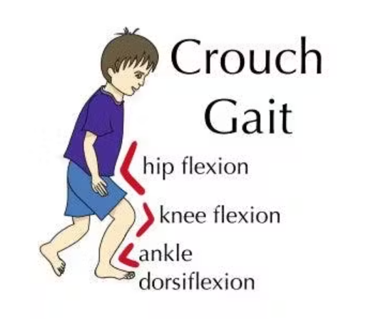 햄스트링 길이 연장술(Hamstring Lengthening)은 골반의 전방경사를 증가시킨다! : 네이버 블로그