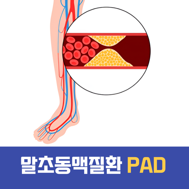 [말초동맥질환(PAD)] 다리로 가는 혈류가 막히는 질환 : 네이버 블로그
