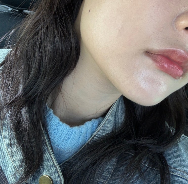 노원 한의원 패인 흉터 치료 새살침 1일차 후기 : 네이버 블로그