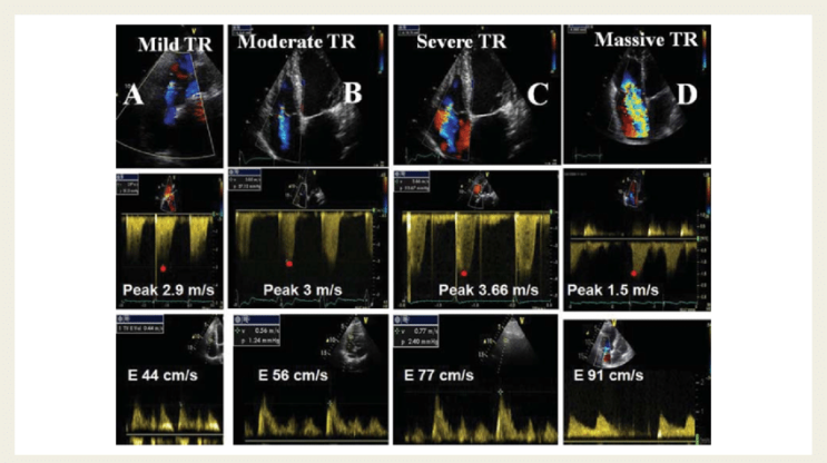TR Vmax, RVSP, RAP의 이해: 심초음파로 보는 우심방·우심실 압력 평가 : 네이버 블로그