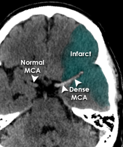 뇌경색(brain infarction) 발생부위별(MCA, ACA, PCA 등) 증상, CT&MRI 기본판독 : 네이버 블로그