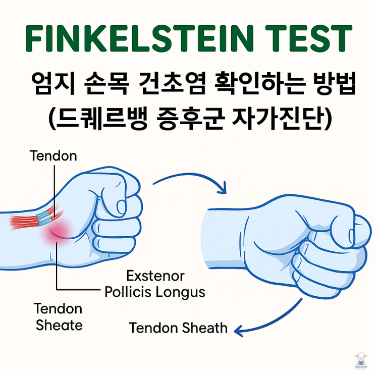 Finkelstein 테스트로 엄지 손목 건초염 확인하는 방법 (드퀘르뱅 증후군 자가진단) : 네이버 블로그