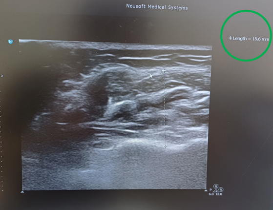 [임상증례 포스팅] 아차산치과에서 알아보는 퇴행성 턱관절디스크 : 네이버 블로그