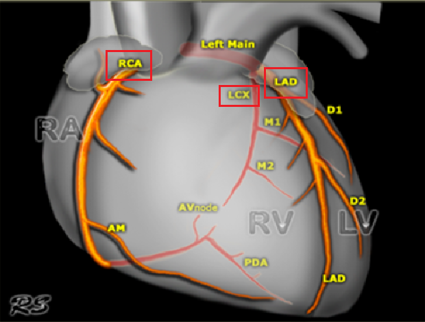 CAG 시술 시 흔히 보는 관상동맥 RCA, LAD, LCX 의미와 심전도(ekg in mi) 특징,변화 : 네이버 블로그