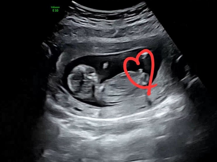 [임신/12w6d] 아인병원 기형아검사(NIPT,니프티,맘가드) / 성별확인 : 네이버 블로그