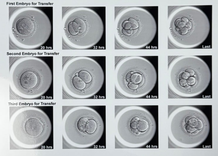 [시험관1차_Ep.09] 배아 관찰경이란(EmbryoScope Time - Lapse)-시험관 성공확률을 높일 수 있다면 뭐든 ...