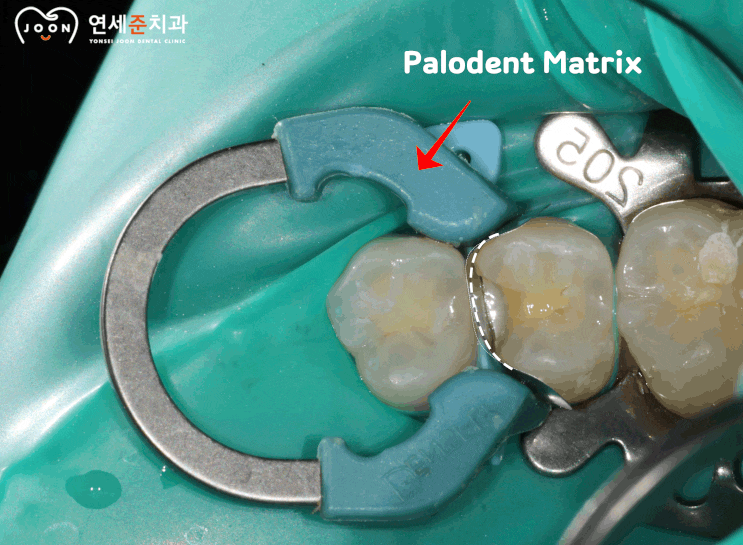 Palodent Matrix 를 이용한 격벽, 도림동 치과 작은 어금니 치아 사이 인접면 레진 충치 치료 : 네이버 블로그