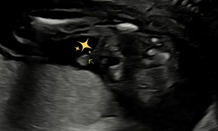 [임신/16w6d] 입덧 끝 / 초음파 성별 확인 / 저위태반 : 네이버 블로그