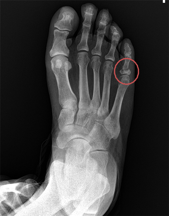 [재활의학과] 자고 일어났더니 발생한 우측 5번째 발가락 골절 / Rt. 5th toe fracture / pinky toe ...