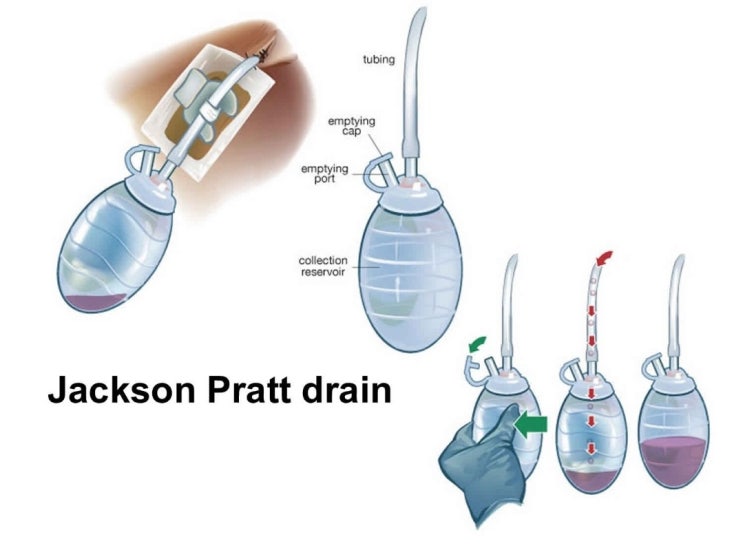“JP Drain vs Hemovac vs Penrose, 신규간호사를 위한 드레인 종류 완전정복!” : 네이버 블로그