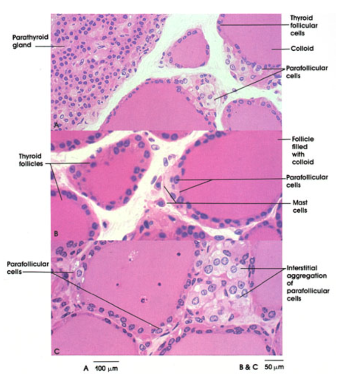 [권주형정형외과] 갑상선 질환, 병리로 꿰뚫어 보기 : 네이버 블로그