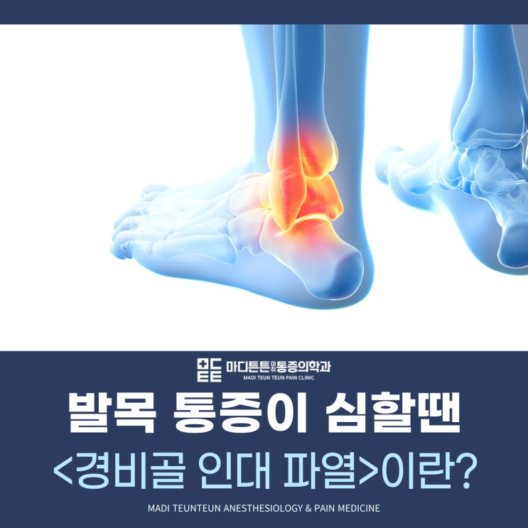인천서구정형외과 운동 후 발목 통증이 심할 때 원인은? : 네이버 블로그