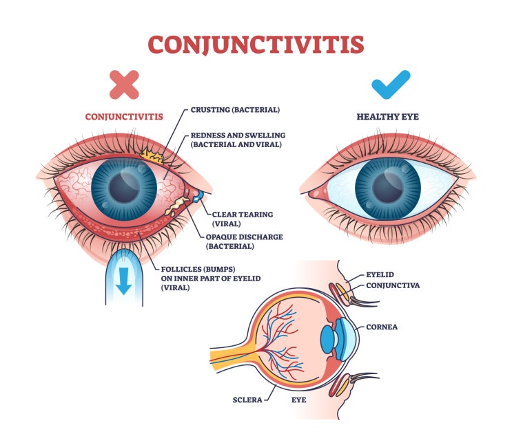 결막이완증(conjunctivochalasis, CCH) 수술에 대해 알아보겠습니다 : 네이버 블로그