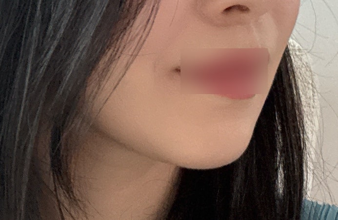 검단피부과 써마지flx 600샷 후기🩷 : 네이버 블로그