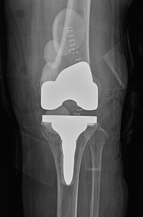 [Knee/TKA]PJI(periprosthetic joint infection) DAIR (Debridement ...