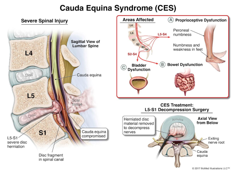 [공부용] Guidelines for Cauda Equina Syndrome Management(말총증후군 치료) : 네이버 블로그